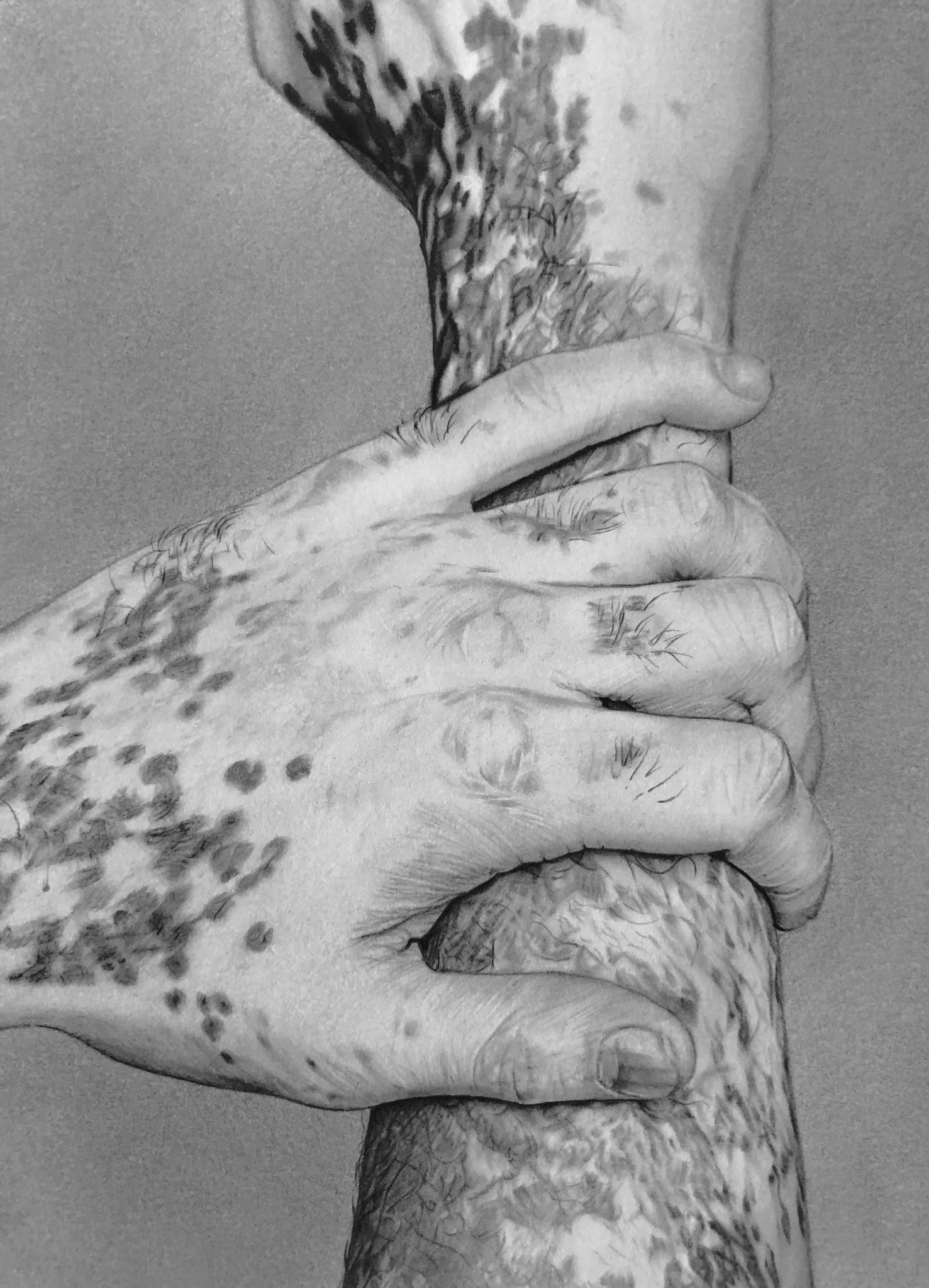Vitiligo – Marion Roy